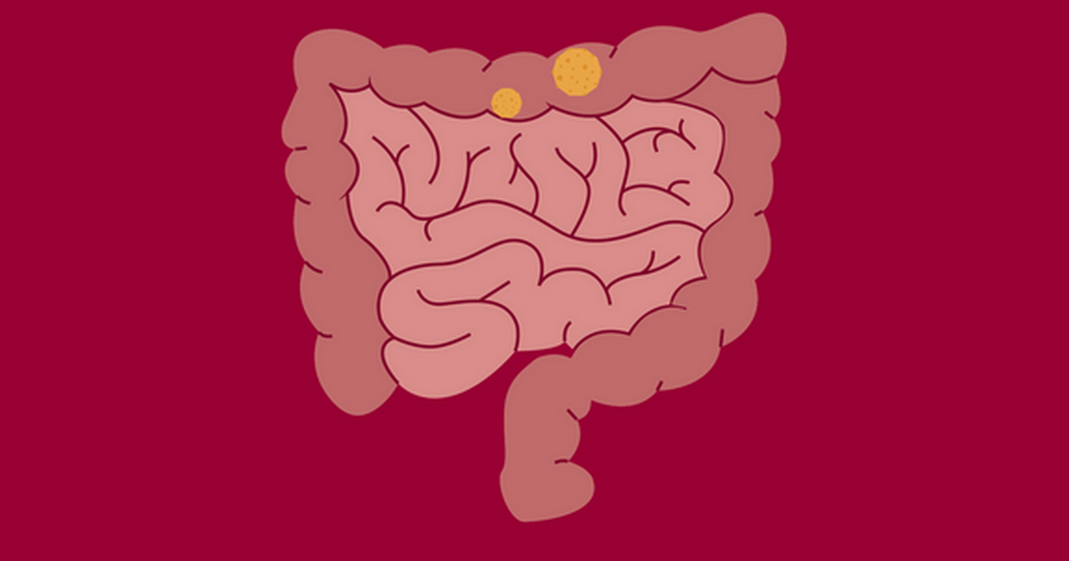 Hurtigere behandling af mave- og tarmkræft patienter - Din Avis