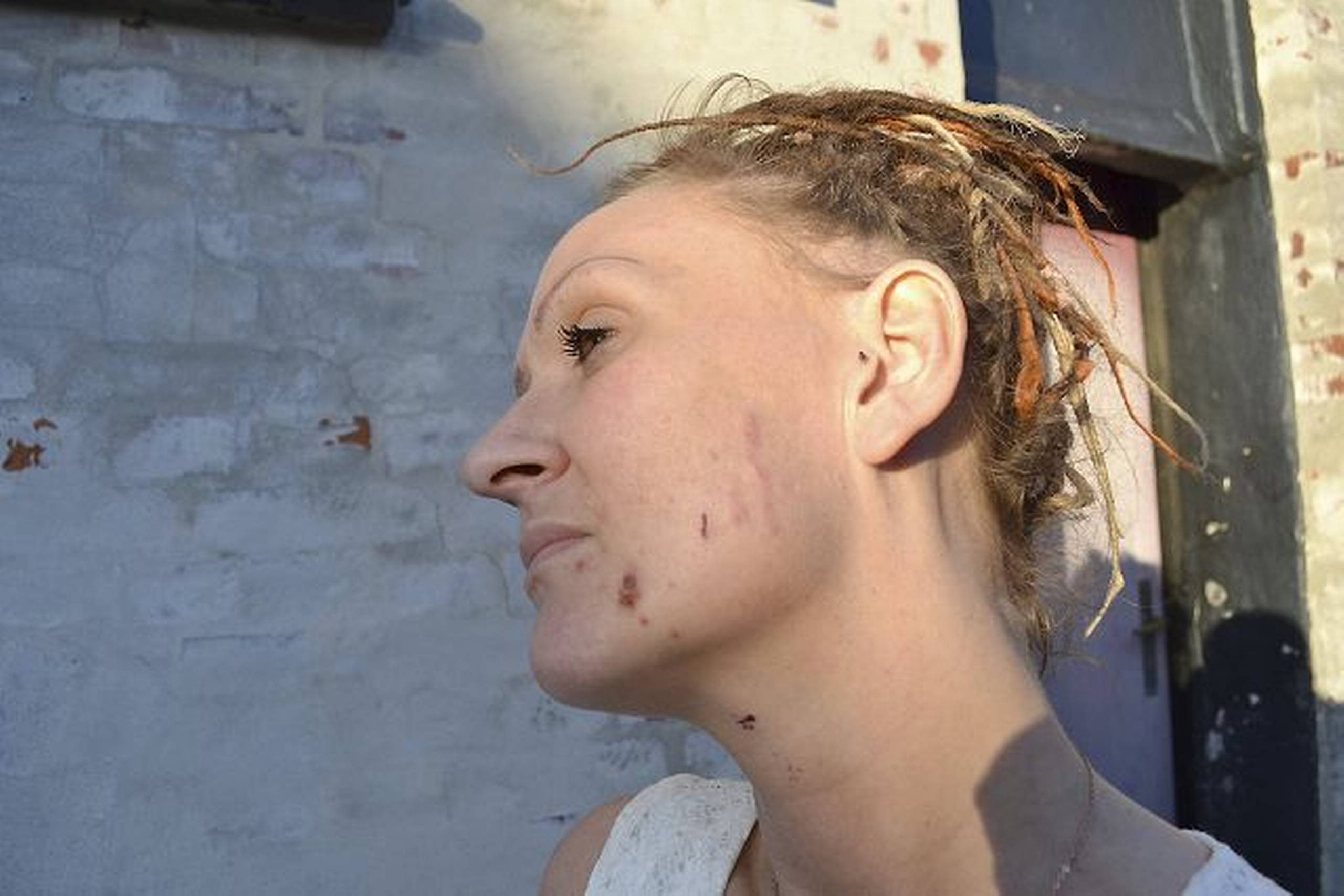 29-årige Chanette bidt i hals, ansigt og arm - sådan ser hun ud dagen ...