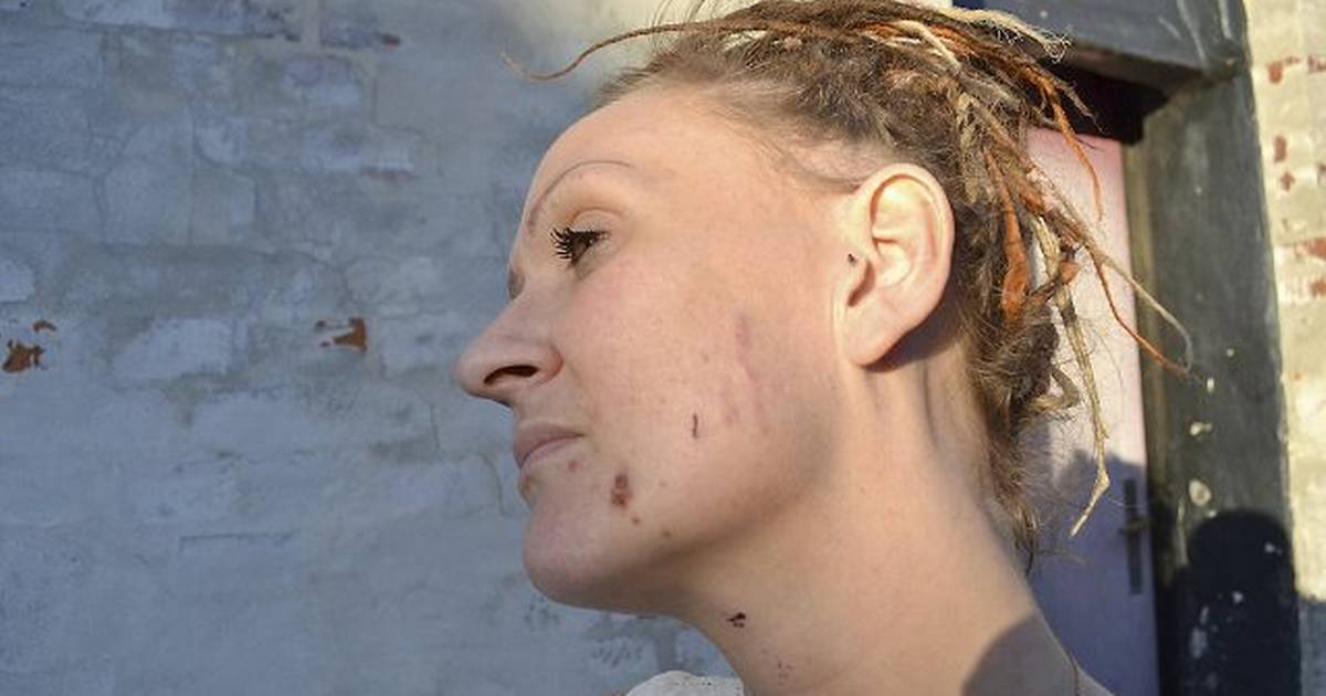 29-årige Chanette bidt i hals, ansigt og arm - sådan ser hun ud dagen ...